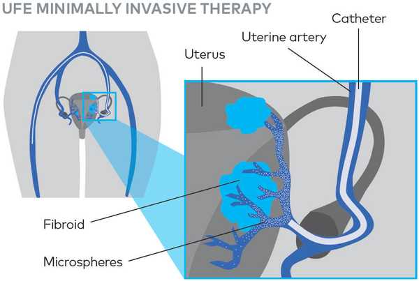 Embolização de mioma uterino (UFE)