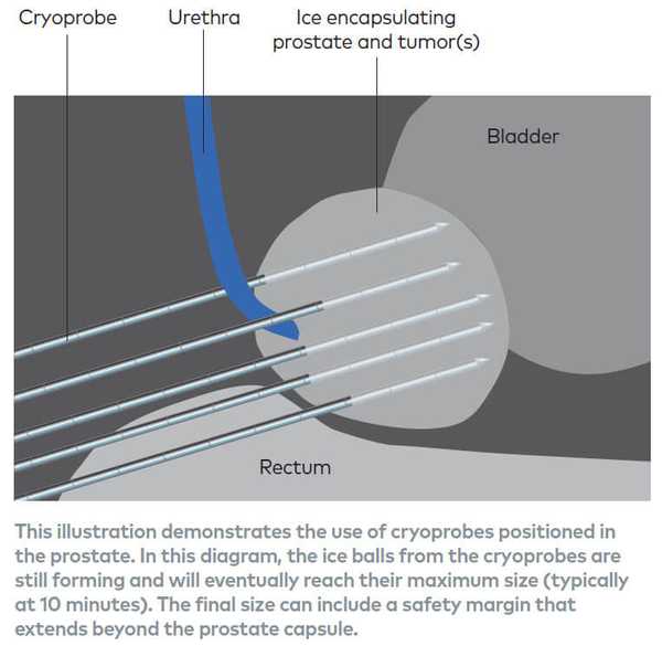 Crioterapia prostática